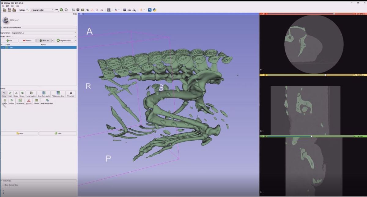 CT data to 3D print in 15 minutes using free software – Prof. Peter L ...
